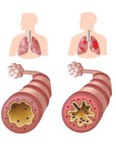 Asthma and FeNO | Bedfont NObreath® FeNO Monitor